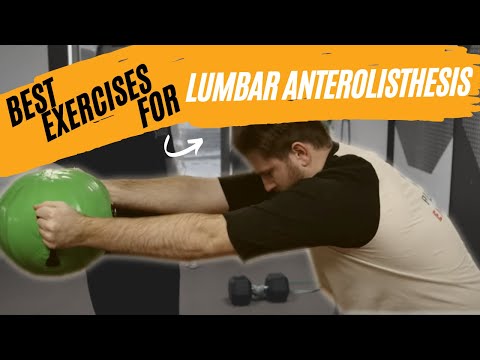 Best Exercises for Lumbar Anterolisthesis