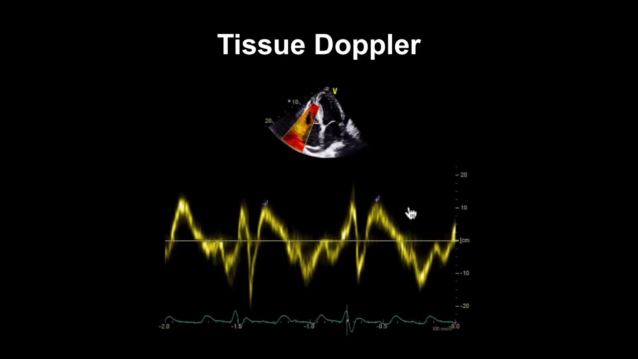 Echocardiography Essentials: Evaluating right ventricular size and function