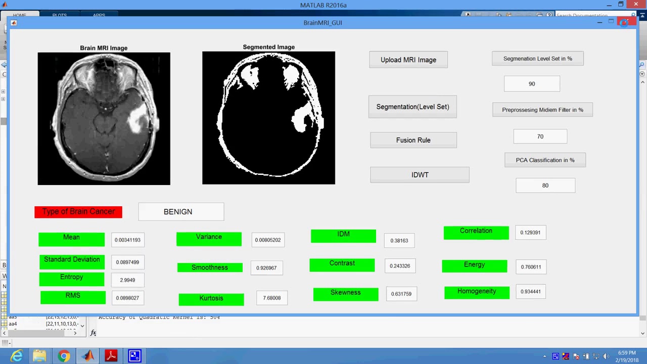 An Enhancement in Detection of Brain Cancer Through image Fusion in ...