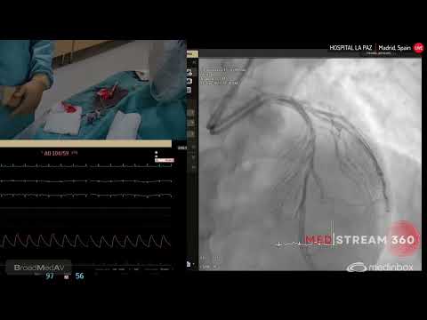 IVUS Guided TCI-DA revascularization