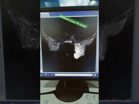 mri breast phyllode tumor