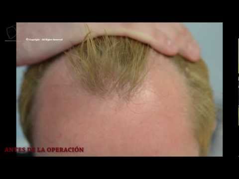 FUE 2207 Ufs MeDiKemos Hair Transplantation ESP