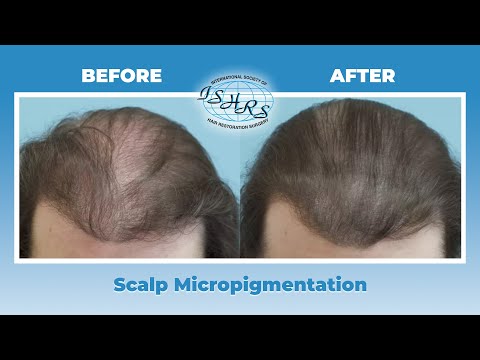 Micropigmentation of Scalp (SMP) - Everything You Need to Know by Dr. Sara Wasserbauer