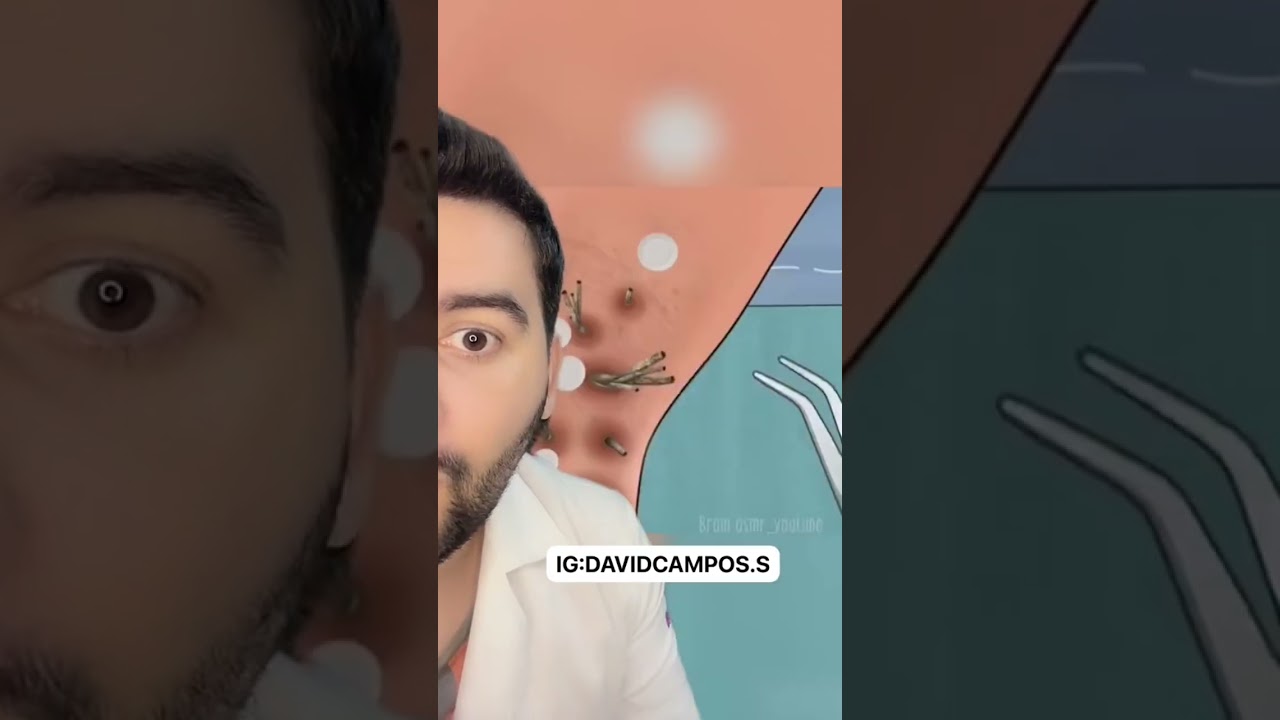 ¿Cómo curar los hongos en las axilas? – LIB ASK