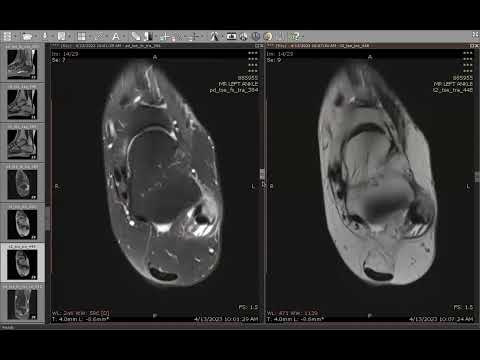 Case 9 ;Split tear of Peroneus Brevis tendon