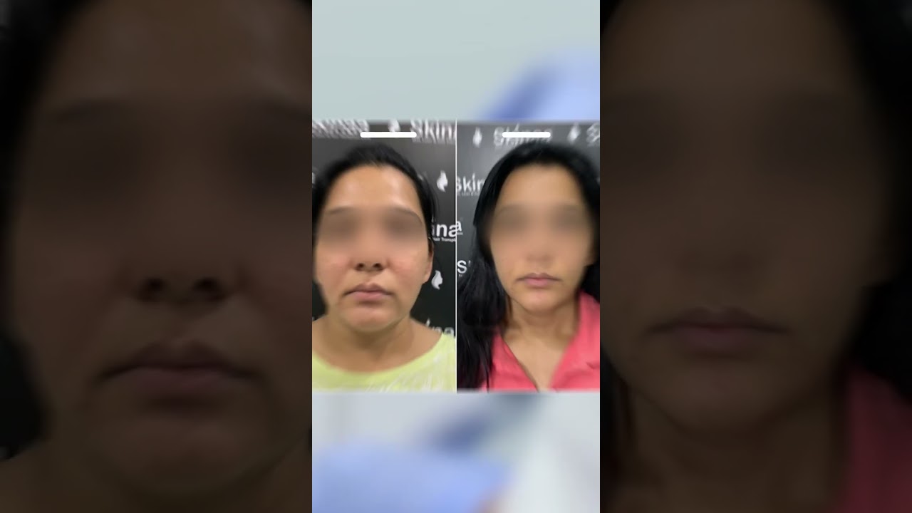 Revolutionize Your Skin with HIFU Treatment | Non-Surgical Facelift for Youthful Skin  #hifu