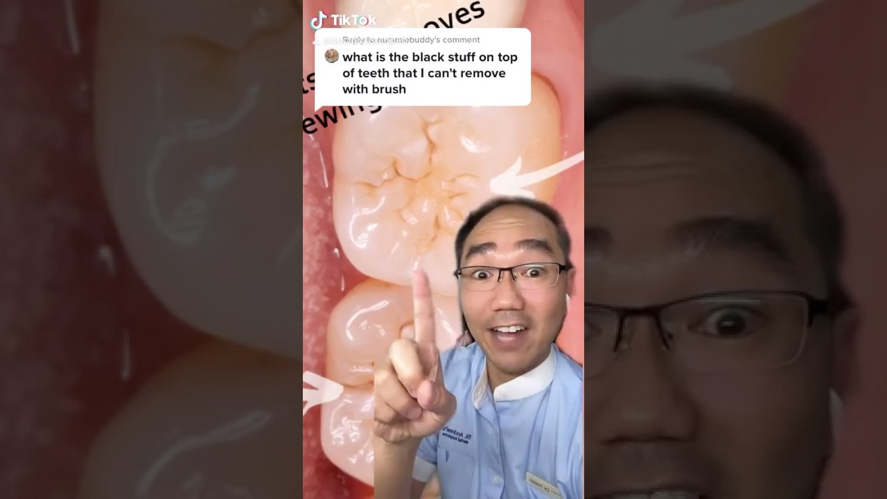 Dark grooves on Molar Back Teeth? 🦷🦷🦷🤩👍