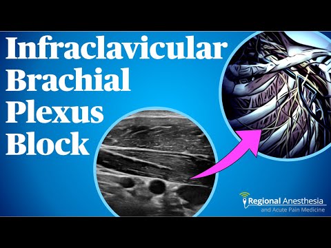Infraclavicular Brachial Plexus Block