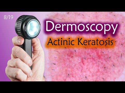 The Dermoscopy of Actinic [solar] Keratosis and their management in Primary Care.