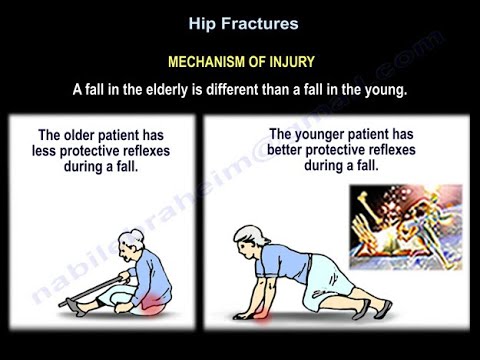 Hip Fractures Mechanism of Injury – Dr. Nabil Ebraheim's Blog