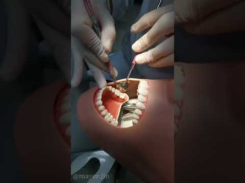 Crown Preparation​ 🦷​ (Part 1) #dentist #crown #prosthodontics​