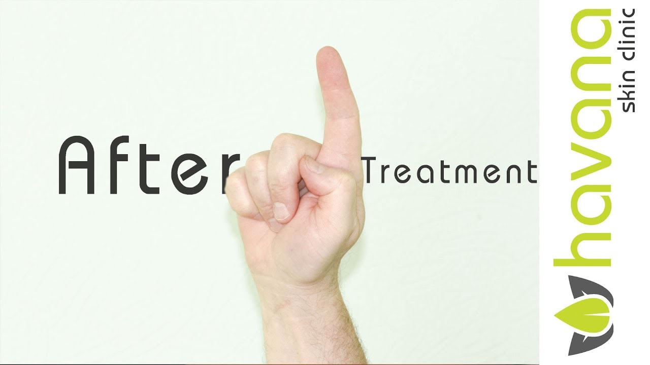 Laser Hair Removal after 1 TREATMENT