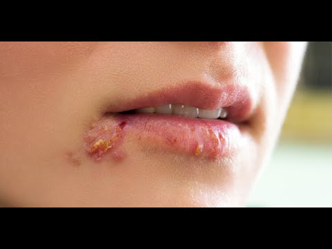 Herpes Labialis and Herpes gingivostomatitis