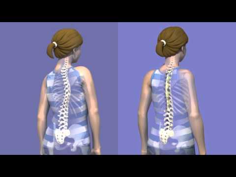 What is Scoliosis surgery?