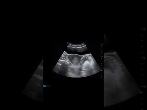 Dermoid cyst in pregnant woman ultrasound, adenexal mass, sonography, ARDMS, ob-gyn