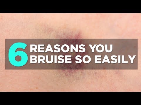 6 Reasons You Bruise So Easily | Health