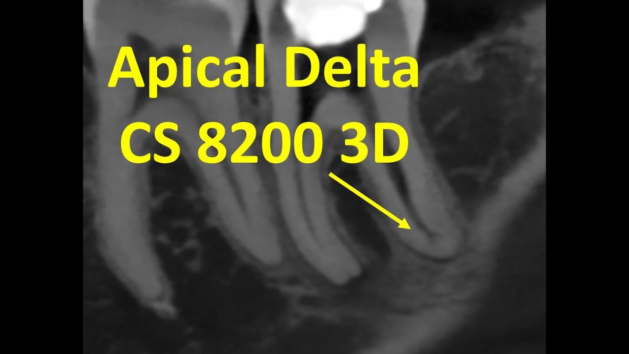CS 3D Imaging - Apical Delta