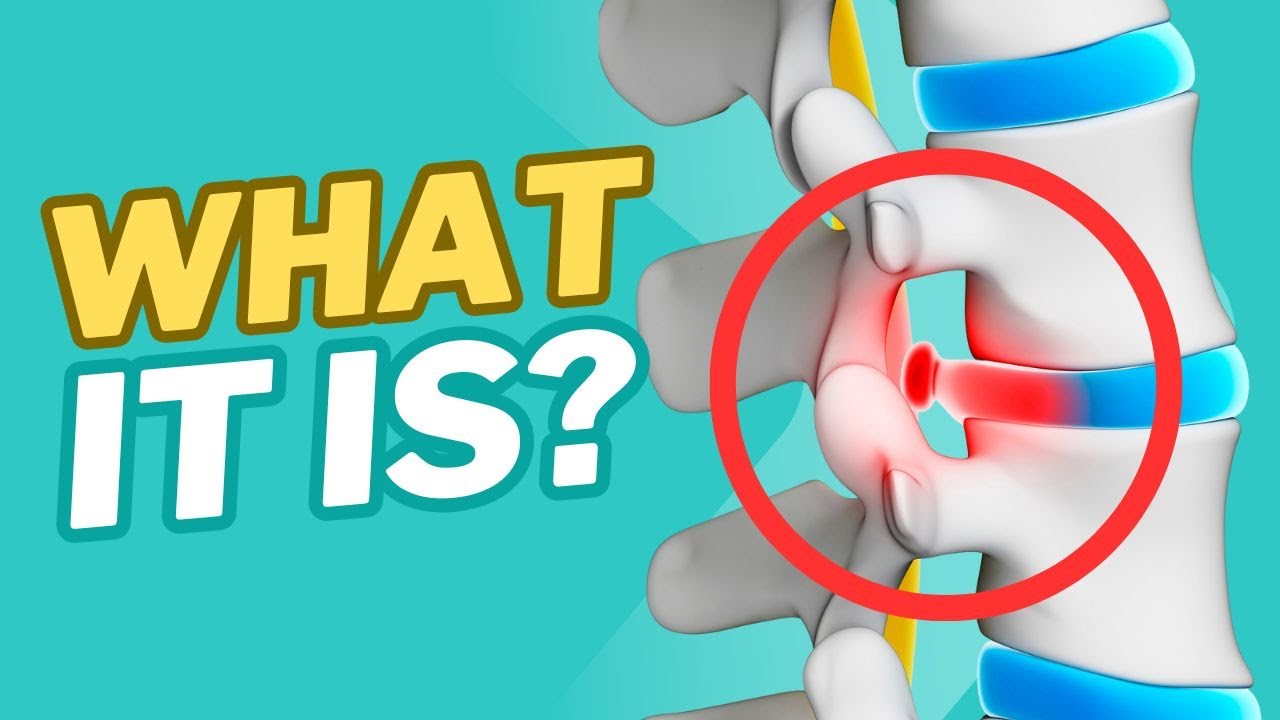 Herniated Disk or Bulging Disk:  What is it? Excellent Demo.