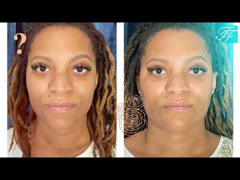 Botox Treatment in Chandler by Flawless Faces Med Spa