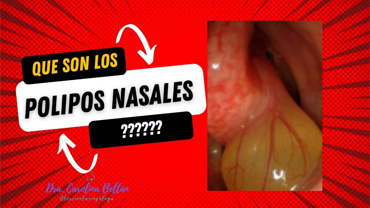 QUE SON LOS POLIPOS NASALES ?