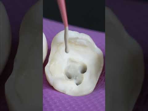 Satisfying Root Canal and Crown Process #shorts