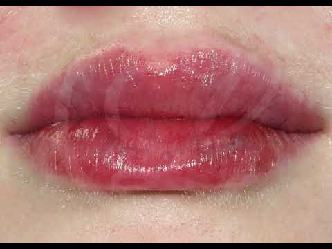 Lip Filler Before and After 7.14.21 | Capek Plastic Surgery