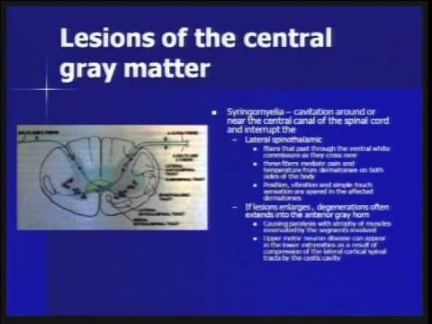 Chronic Spinal Cord Impairment: Stenosis and Syrinx Formation
