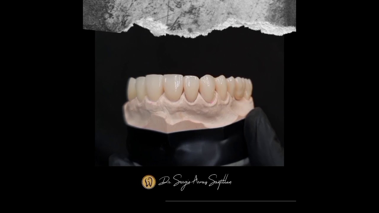 Restauraciones de porcelana disilicato de litio - Dr. Sergio Armas Santillán