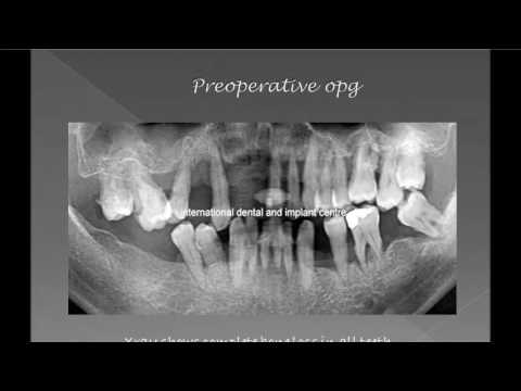 full mouth implant treatment in chennai