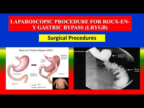 LAPAROSCOPIC PROCEDURE FOR ROUX-EN-Y GASTRIC BYPASS (LRYGB)