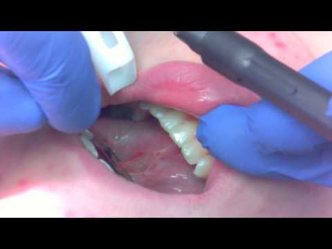 Adult Tongue Tie Release