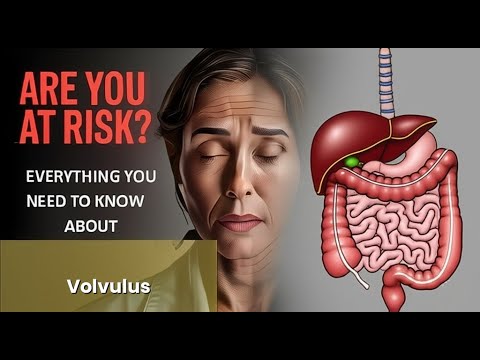 Volvulus Explained Causes, Symptoms and Treatment, All Insights