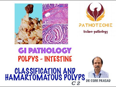 Intestinal Polyps - Classification and Hamartomatous Polyps