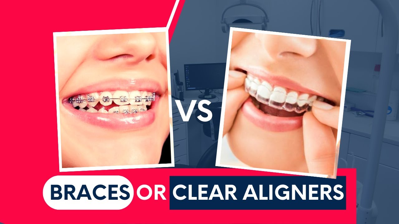 Invisalign OR Metal Braces | Which should you choose to straighten your teeth?