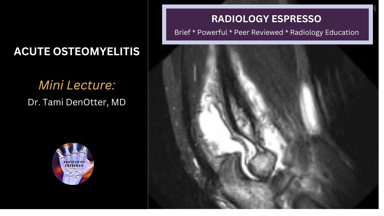 ACUTE OSTEOMYELITIS: Mini Lecture, Dr. Tami DenOtter, MD