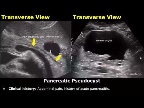 Pancreas Ultrasound Reporting | Diseases Scan Reports | How To Write USG Report | Abdominal USG