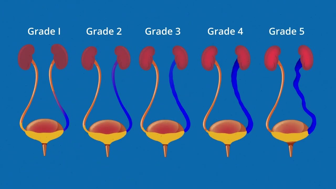 What is Vesicoureteral Reflux (VUR) - Animated Video