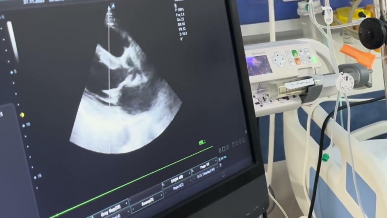 How to Assess LV Function Using EPSS | Quick POCUS Guide