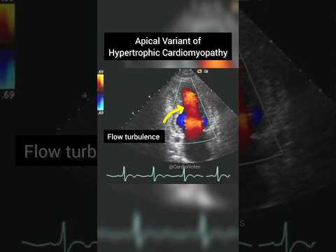 Apical Variant of Hypertrophic Cardiomyopathy on Echocardiography #anatomy #heart