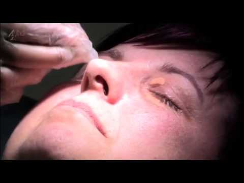Specialist Skin Clinic treats Xanthelasmata on Embarrassing Bodies