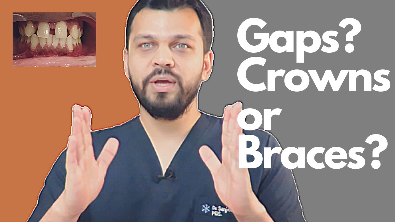 Dentist Explains : Treatment options for Gaps Between Front Teeth