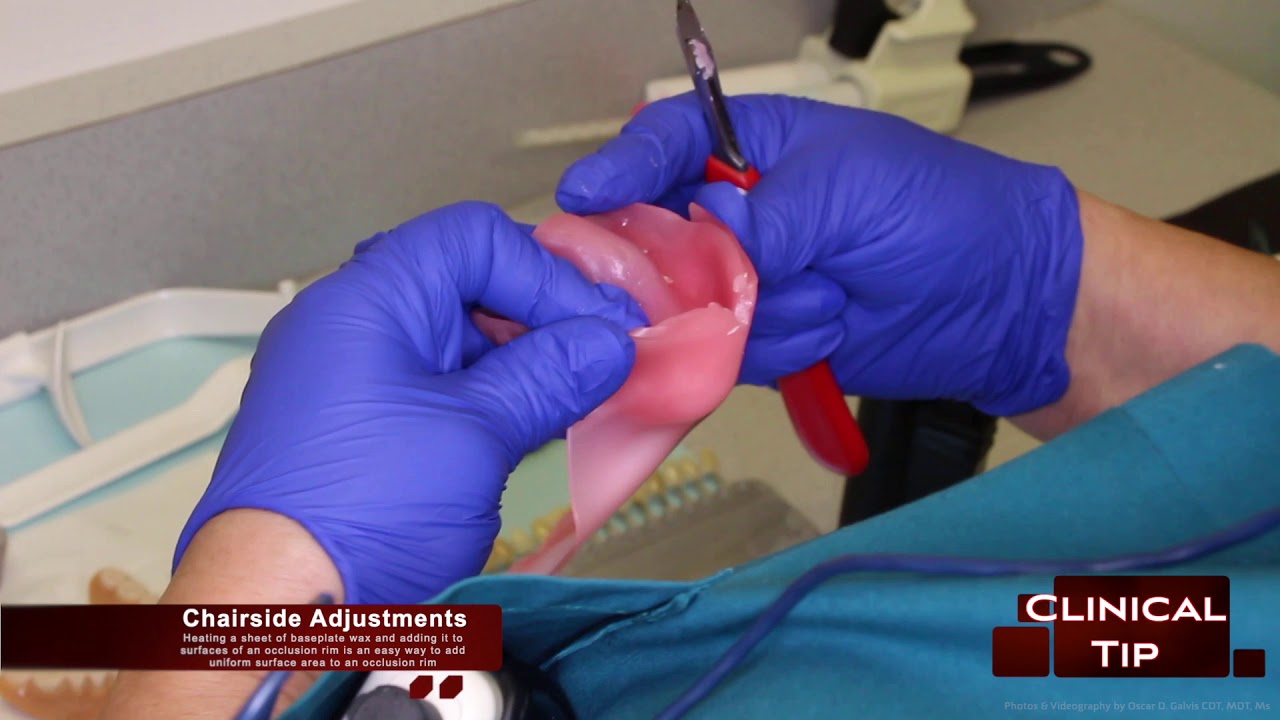 CDJ: 7) Occlusal Rim Appointment