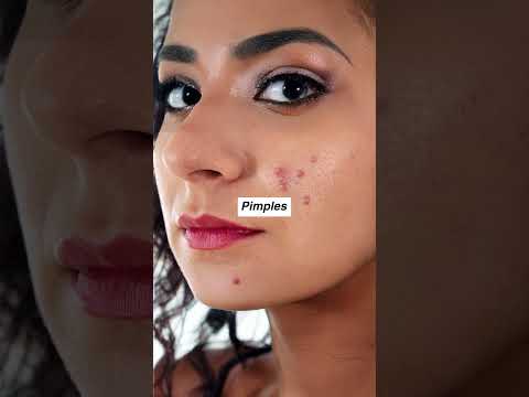 Adapalene Gel | Indian Pharmacy Skincare #blackheads #acne #shorts