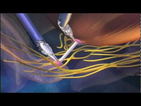 What is a robotic prostatectomy?
