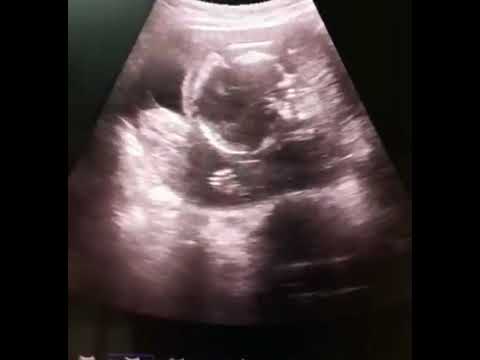 This is very rare asingle pregnancy seen in right rudimentary horn of a bicornuate unicolis uterus.