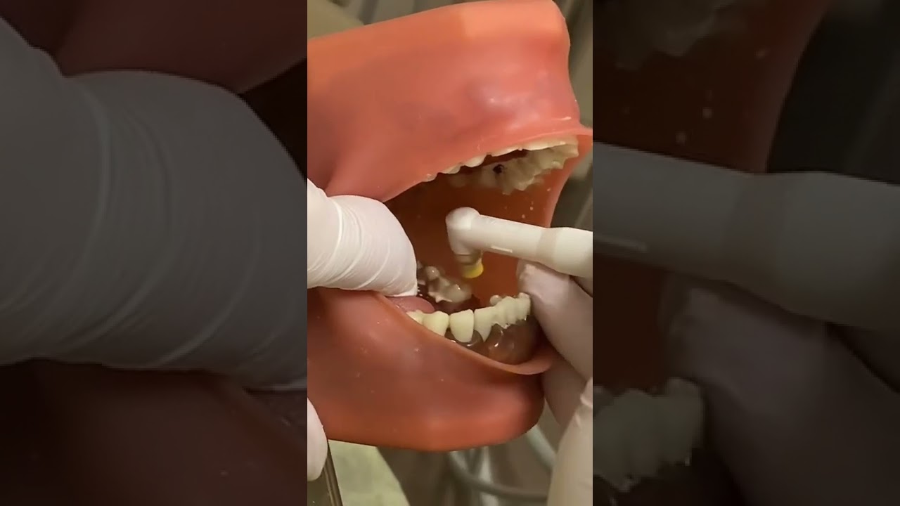 Coronal Polishing