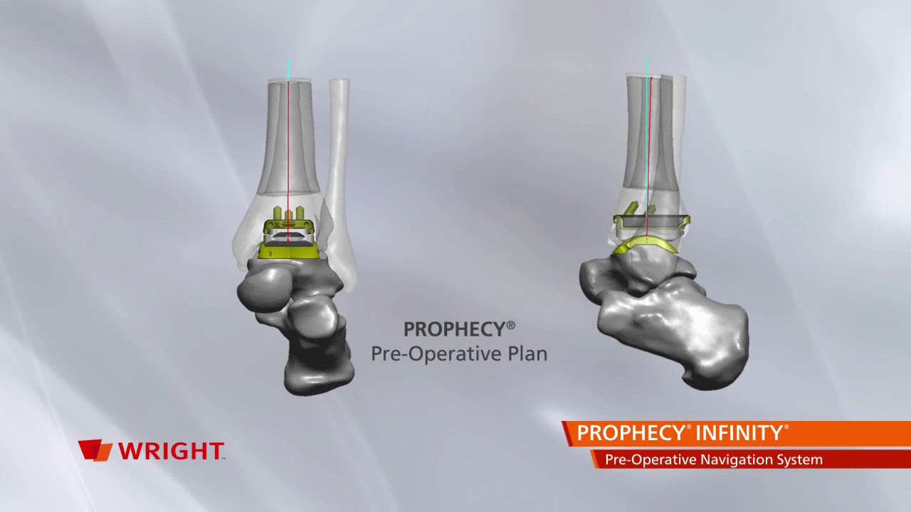 Wright TAR patient video PROPHECY INFINITY