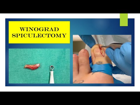 Video - Winograd spiculectomy