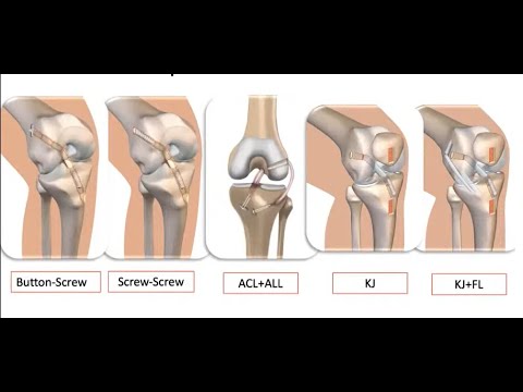 ACL and ALL Reconstruction: Techniques and Indications