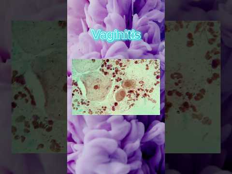 VAGINITIS - DEFINICIÓN MÉDICA | Interpretación Consecutiva Medical